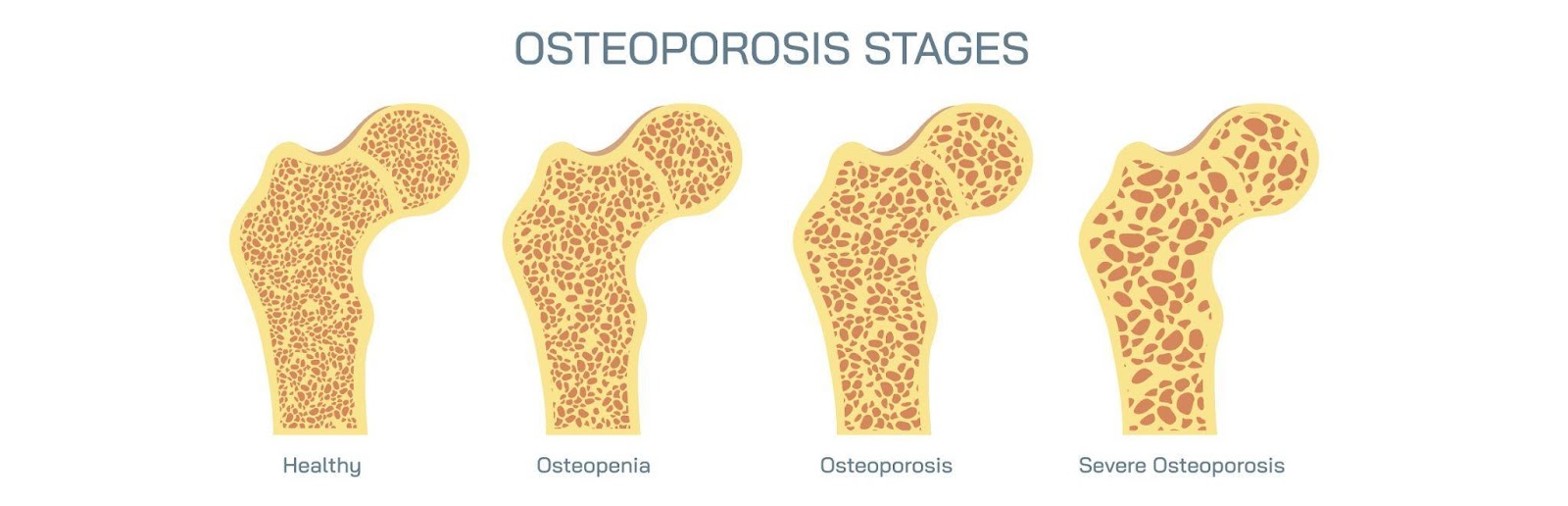 Bone Building Therapy (Anabolic Therapy for Osteoporosis) - The ...