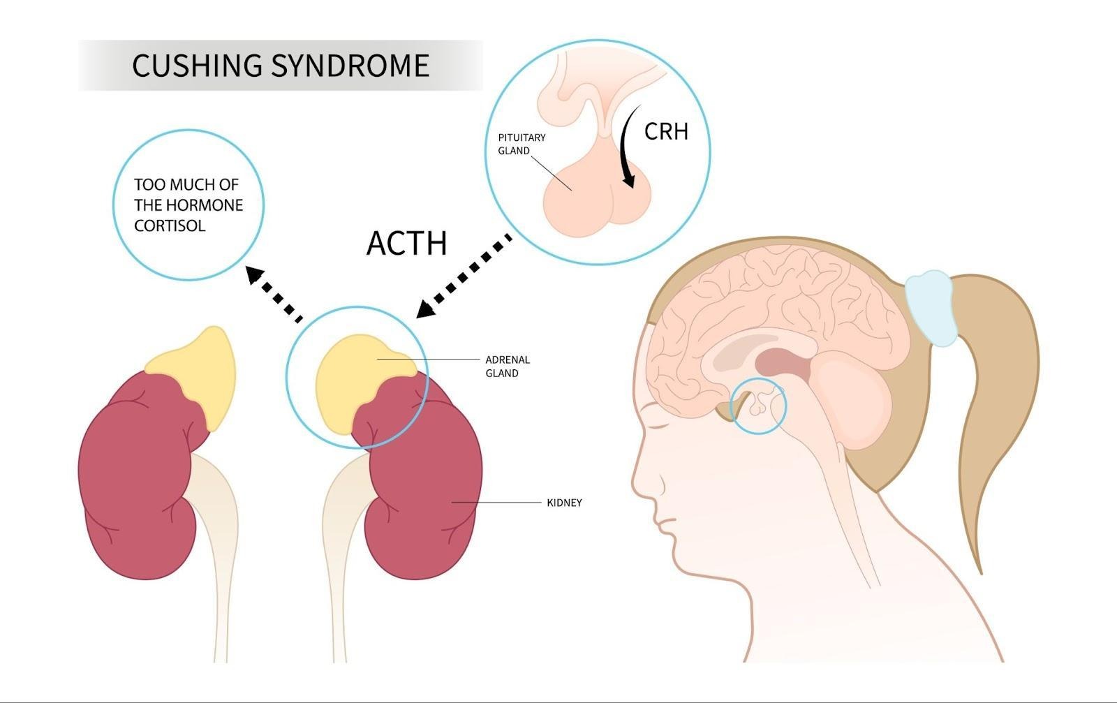 Cushing’s Syndrome/ Excess Cortisol - The Metabolic Clinic