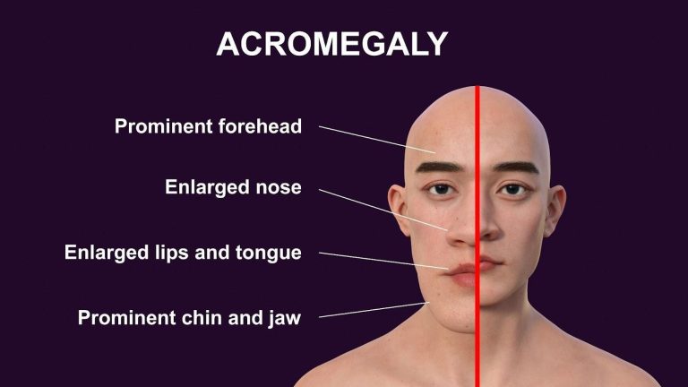 Acromegaly/ Excess Growth Hormone - The Metabolic Clinic